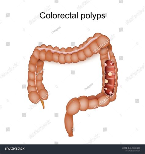 Polyp In Colon Image Over 1 010 Royalty Free Licensable Stock Illustrations And Drawings