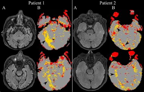 Patient 1 Left And Patient 2 Right A Fluid Attenuated Inversion Download Scientific