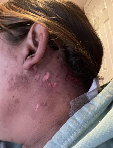 Shingles Around Ear And Neck R Shingles