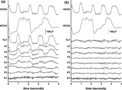 A Five Second Epoch Of Raw Eog And Eeg Signals Containing Prominent