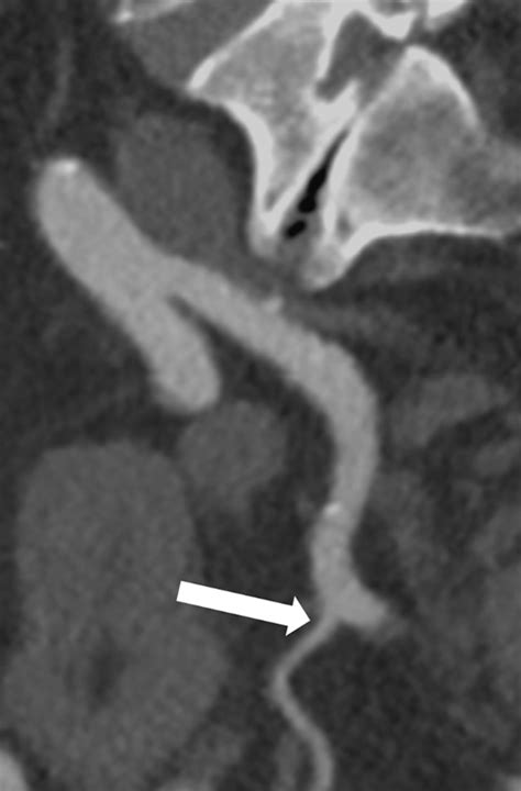 Prostatic Artery Embolization Indications Preparation Techniques Imaging Evaluation