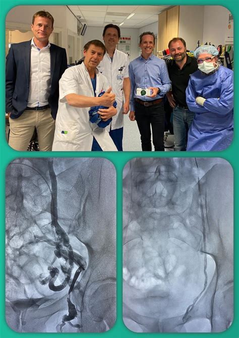 Angiocare On Linkedin Peripheralembolization