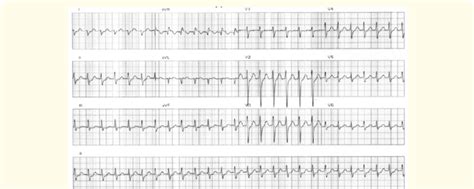 Typical Avnrt Narrow Complex Tachycardia Absent P Waves With Regular
