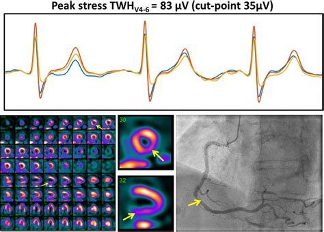 True‐positive Myocardial Perfusion Imaging Mpi Case Confirmed By Download Scientific Diagram
