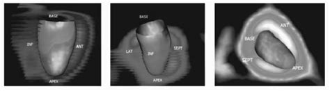 Perfusion Map Corresponding To Es Displayed In Different Views See