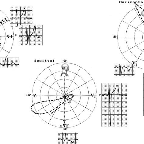 Vcgecg Correlation Frontal Plane Initial 1020 Ms Vector Heading Download Scientific Diagram