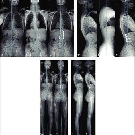 Patient Presenting With A Lenke 1an Curve On The Ap Standing