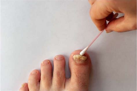 How To Remove Dead Toenail Causes Symptoms And Treatment