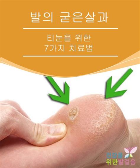 발의 굳은살과 티눈을 위한 7가지 치료법 Cor Au Pied Soin Des Pieds Remèdes Maison