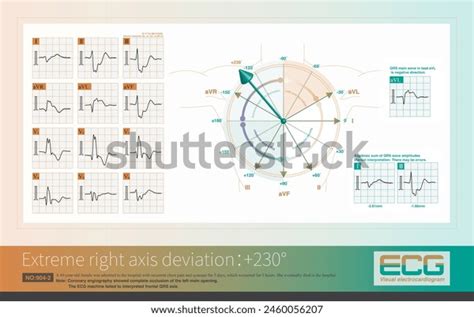 Acute Left Main Occlusion Left Ventricular Stock Illustration 2460056207 Shutterstock