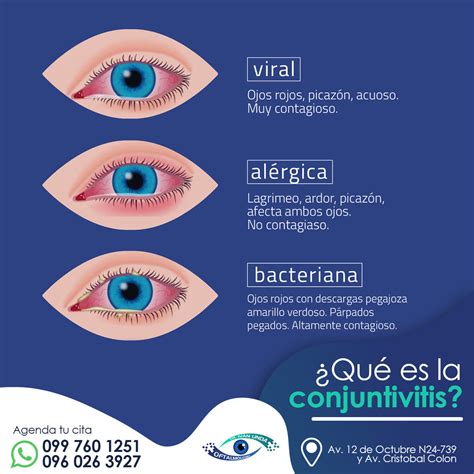 Dr Ivan Unda Oftalmologo Quito La Conjuntivitis Es Una Inflamación