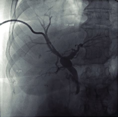 Percutaneous Transhepatic Cholangiogram And External Biliary Drain