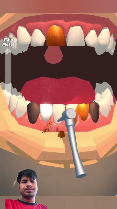 Why Do Dentists Use Gold Teeth Youtube