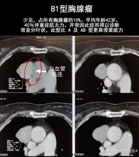 胸腺癌治疗那些事（十四） 知乎