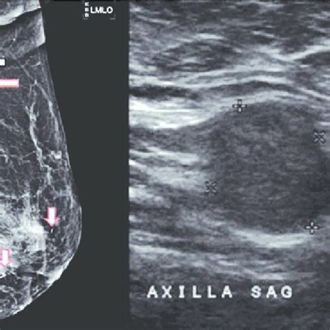 Pdf Abnormal Axillary Lymph Nodes On Negative Mammograms Causes