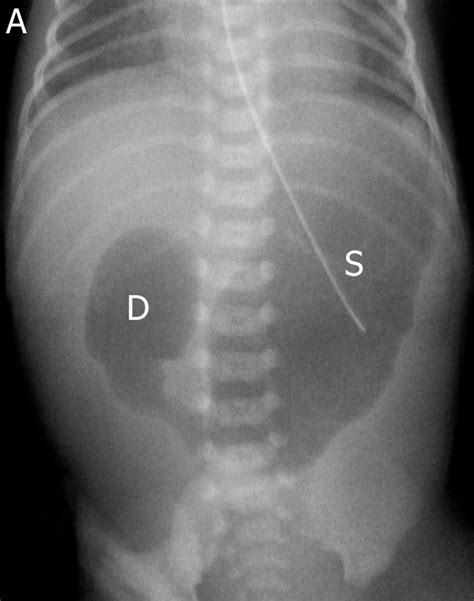 Annular Pancreas Ultrasound