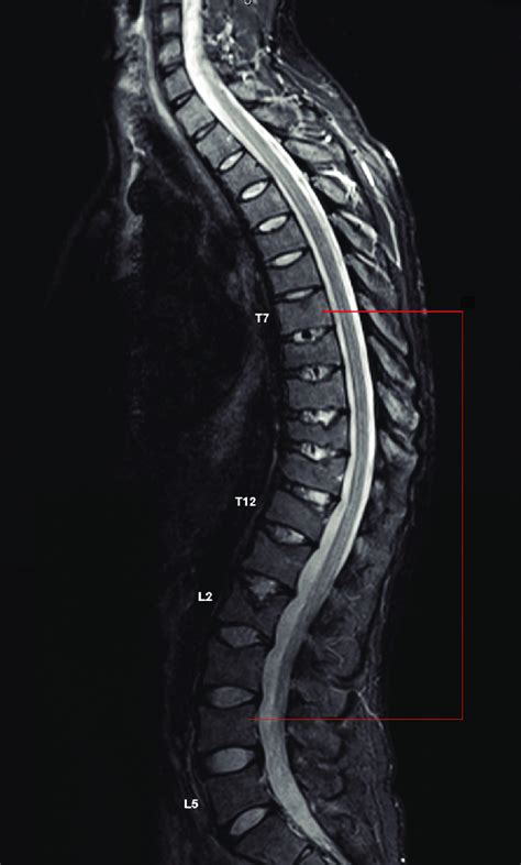 Mri Of The Thoracic And Lumbar Spine Download Scientific Diagram