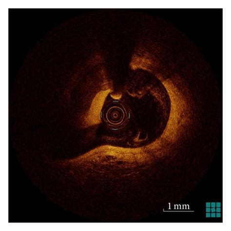A Shows A Cross Sectional Ivus Image With Visible Calcification And
