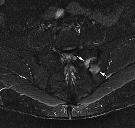 Sacroiliac Joint Dysfunction Mri