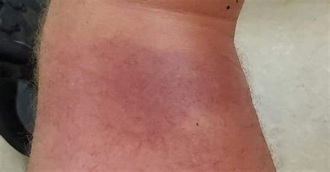 Infected Bee Sting Album On Imgur