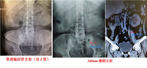 泌尿外科病院覆膜支架造福复杂性输尿管狭窄患者 陕西省人民医院泌尿外科病院