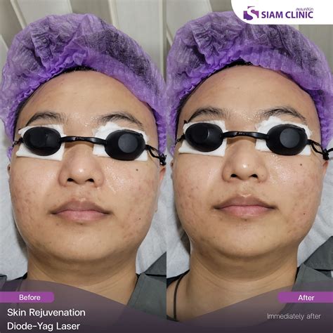 Brightening Treatment Before And After Photos Siam Clinic Thailand