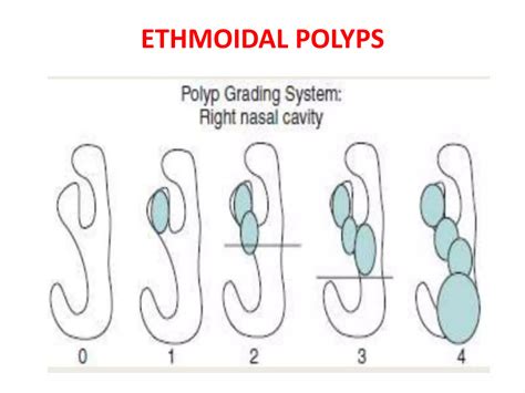 Nasal Polyps Pptx Ear Nose And Throat Conditions Diseases And Conditions
