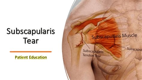 Subscapularis Tear Symptoms Diagnosis And Treatment Orthofixar