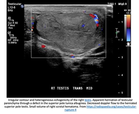 Emergency Medicine Educationem 3am Testicular Rupture
