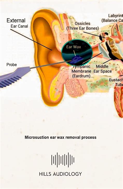 Microsuction Ear Wax Removal Professional Ear Cleaning Services
