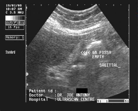 A Gallery Of High Resolution Ultrasound Color Doppler And 3d Images Cholecystectomy