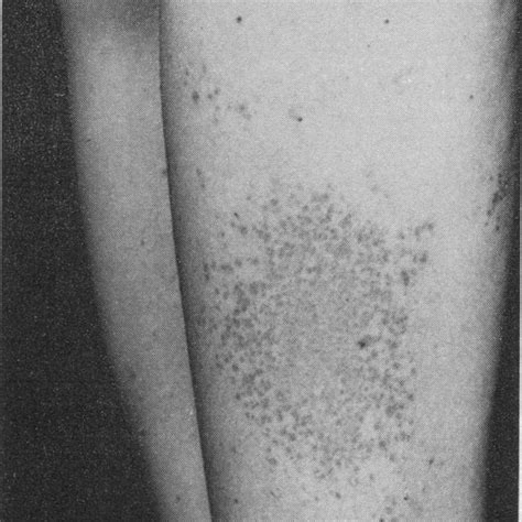 Pdf Is Micropapular Sarcoidosis Tuberculosis