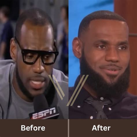 Lebron James Hair Transplant Before And After Transformation