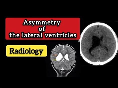 Asymmetry Of Lateral Ventricles Radiology Youtube