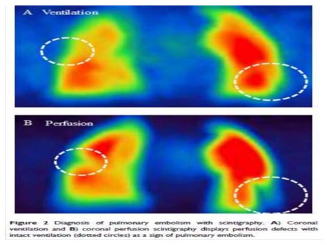 Pulmonary Embolism Radiology Pptx