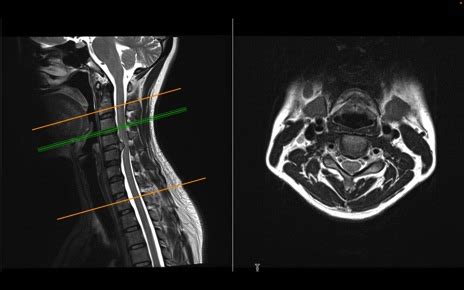 整形TIPS症例6 頚椎MRI T2WI 矢状断像と横断像