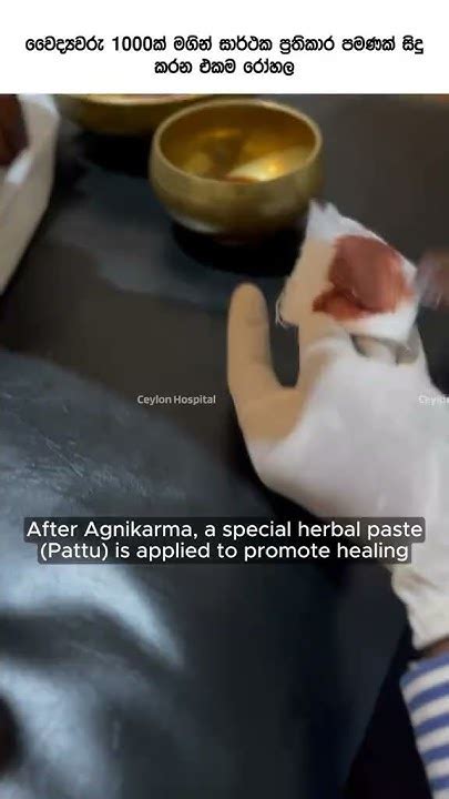 🧱 ගල් තැලුම් සුව කරන අග්නිකර්මඔබත් දෙස් විදෙස් රටක රෝගයක් නිසා පීඩා විදින අයෙක්ද Youtube