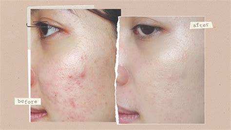 How To Hide Red Spots On Face Without Makeup Saubhaya Makeup