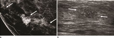 Clinical Significance And Pathologic Outcomes Of Coarse Heterogeneous Calcifications Detected On