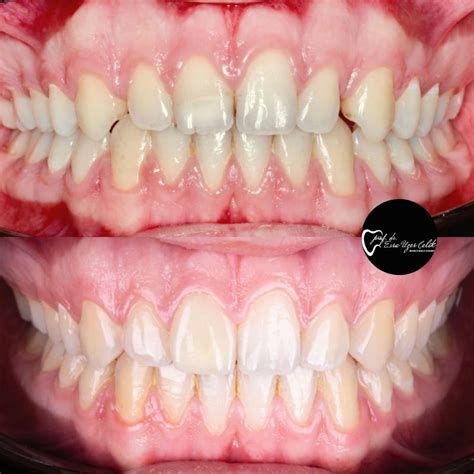 Flowable Composite Resins With Kulzer Esra Uzer Çelik Posted On The Topic Linkedin