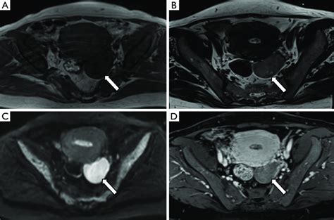 Mri Scans Showed A Mass In The Left Adnexal Area White Arrow A The Download Scientific