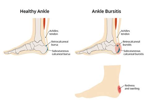 Retrocalcaneal Bursitis