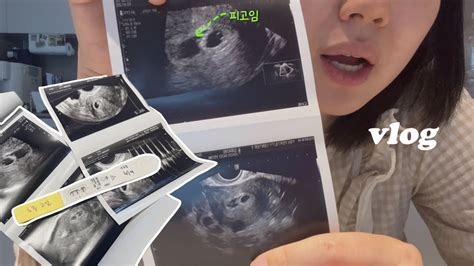 임산부 브이로그🤰🏻 L 불안이 일상인 시험관임신 5주~6주 피고임 눕눕 고사난자 이후 첫 난황 그리고ep39 Youtube