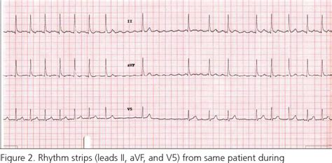 Type Ii Atrial Flutter Icd 10 Jordfranchise