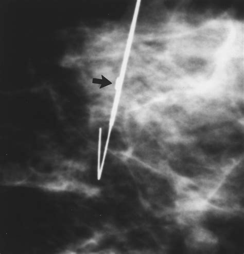 Needle Localization Cpt Code At Palmer Ellerbee Blog