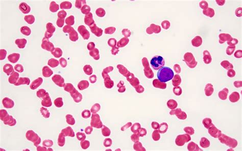 Pathology Outlines Aml With Runx1t3cbfa2t3glis2