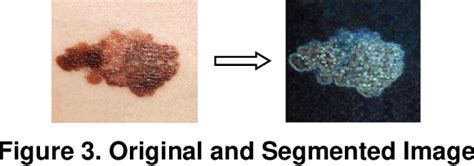 Figure From Melanoma Detection In Dermoscopic Images Using Global And Local Feature Extraction