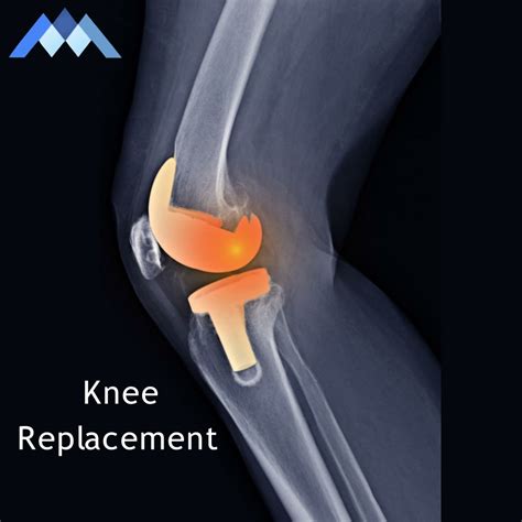 Ppt Knee Replacement Powerpoint Presentation Free Download Id12815181