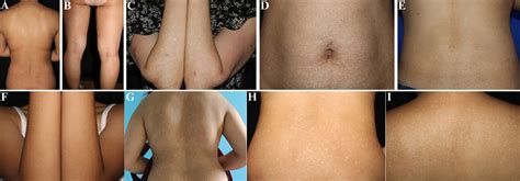 Jle European Journal Of Dermatology Diffuse Hyperpigmentation With