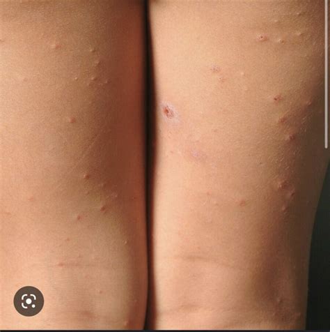 Derma Flashcards Quizlet